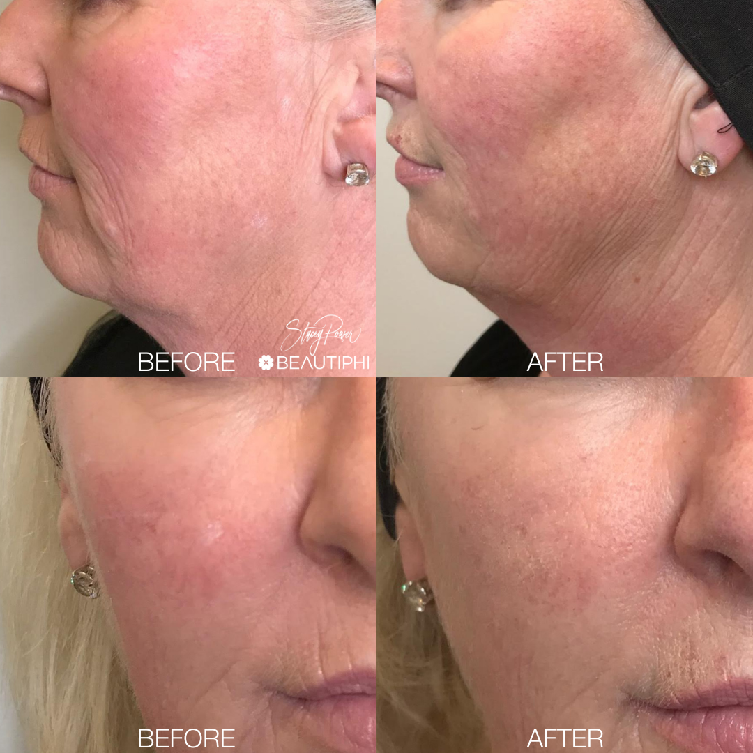Profhilo Filler Injection Auckland - Skin Treatment Beautiphi